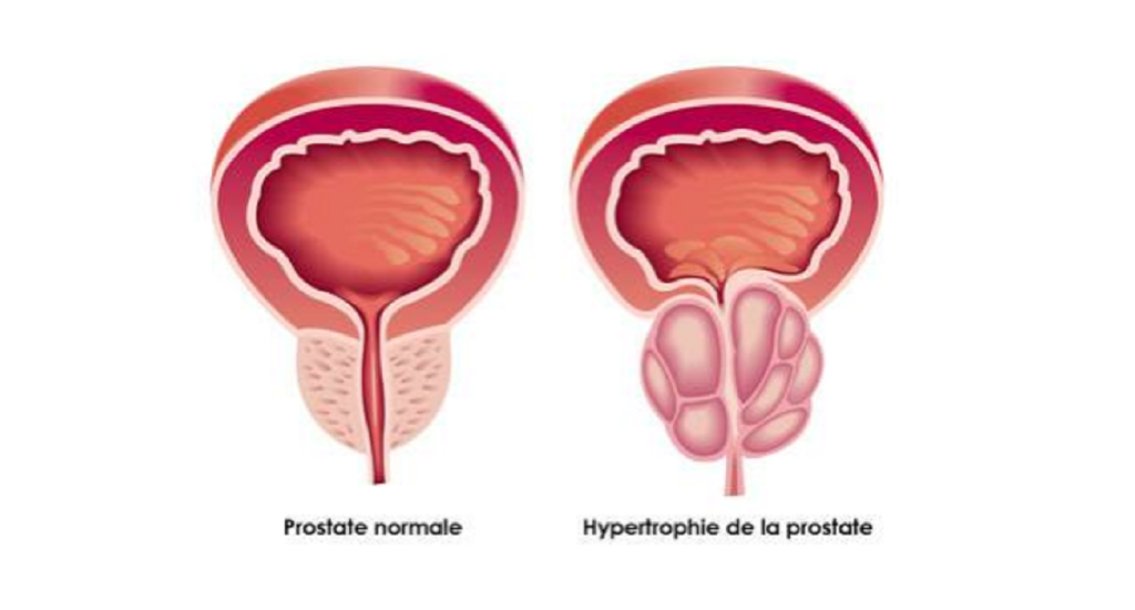 Traitement De Lhypertrophie De La Prostate Urologue Dole